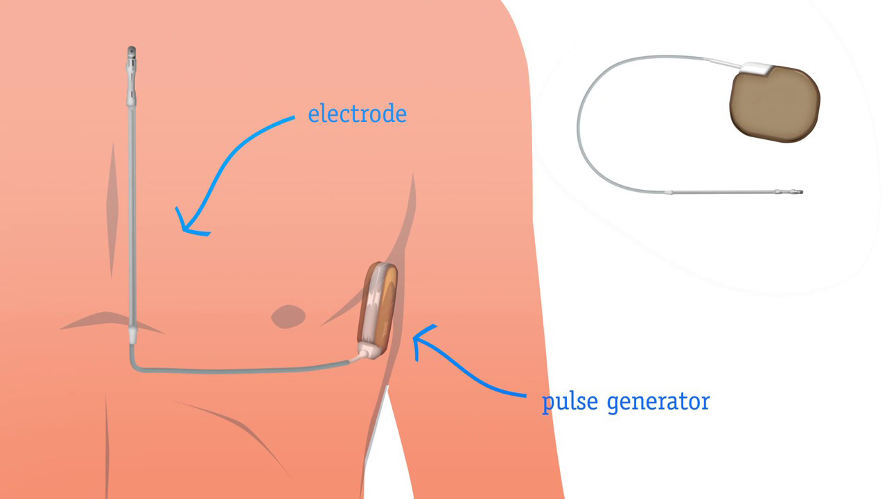 S-ICD - vs transveneous ICD and Pacemakers S-ICD - vs transveneous ICD and Pacemakers